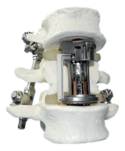 Vertebral body replacement « OrthoLoad